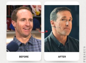 Celebs with hair loss: How do they cope? - Perseus Hair Care