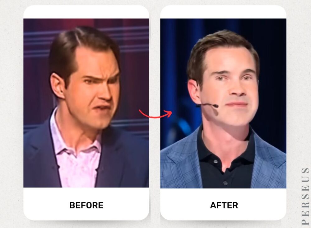 Celebs with hair loss: How do they cope? - Perseus Hair Care