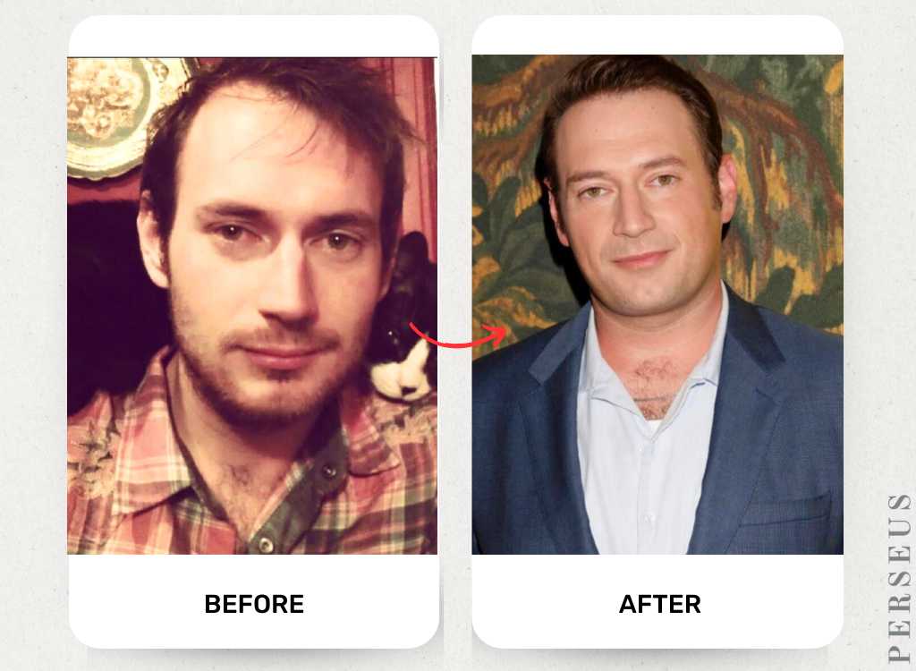 Celebs with hair loss: How do they cope? - Perseus Hair Care