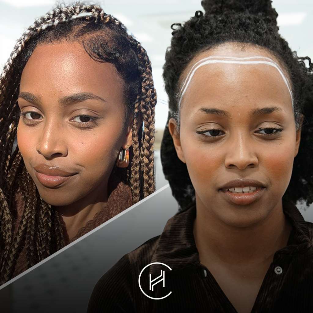 Afro Hair Transplant in Turkey (2025) - Perseus Hair Care