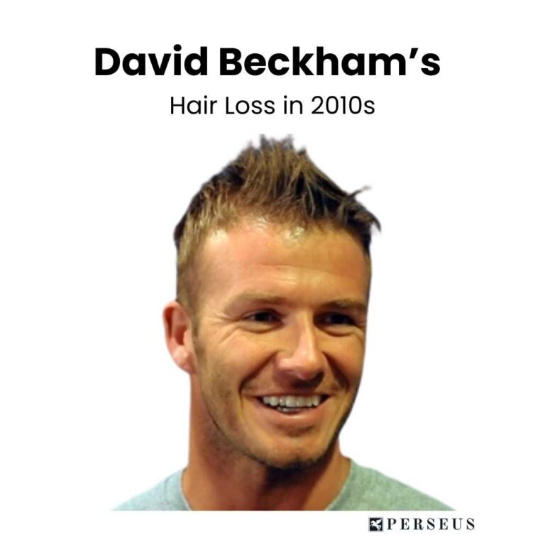 David Beckham's Hair Transplant: Expert Opinions - Perseus Hair Care