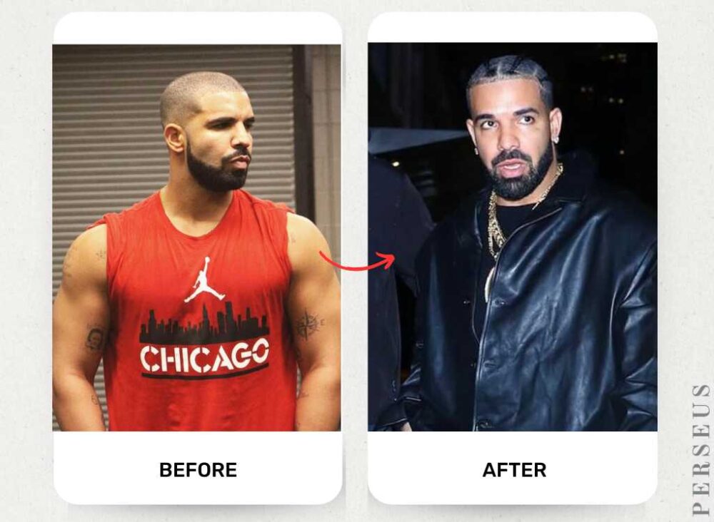 Celebs with hair loss: How do they cope? - Perseus Hair Care