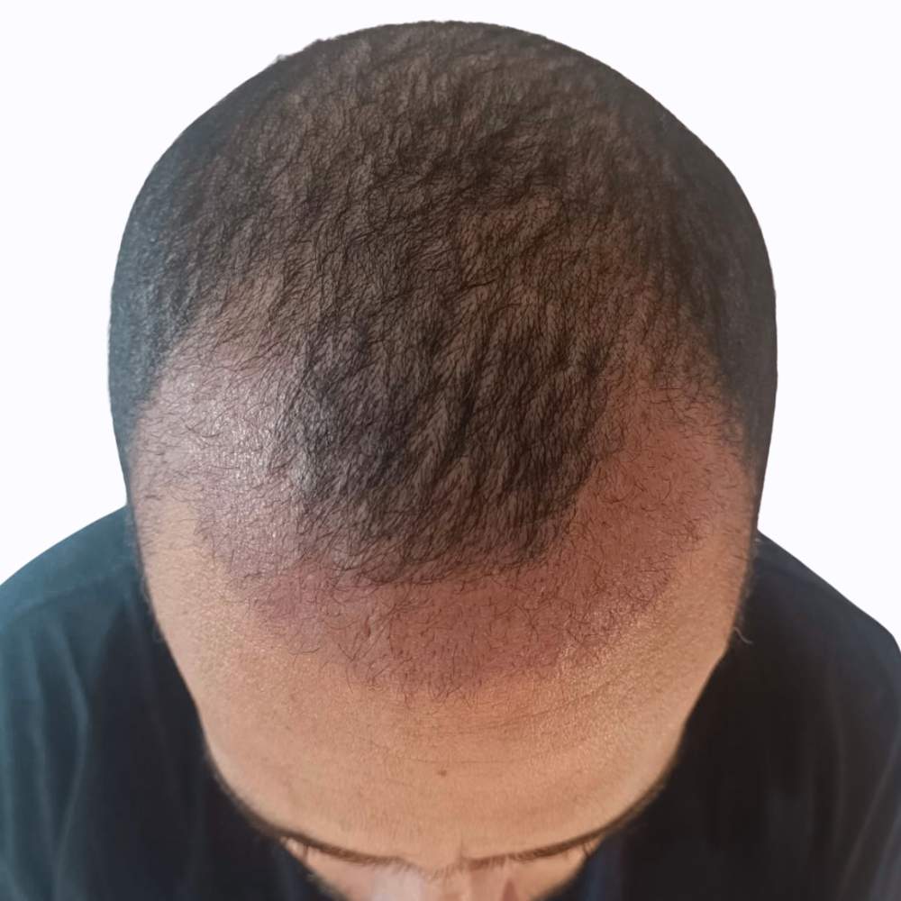 Recovery Progress with Photos - Month 2 - Perseus Hair Care