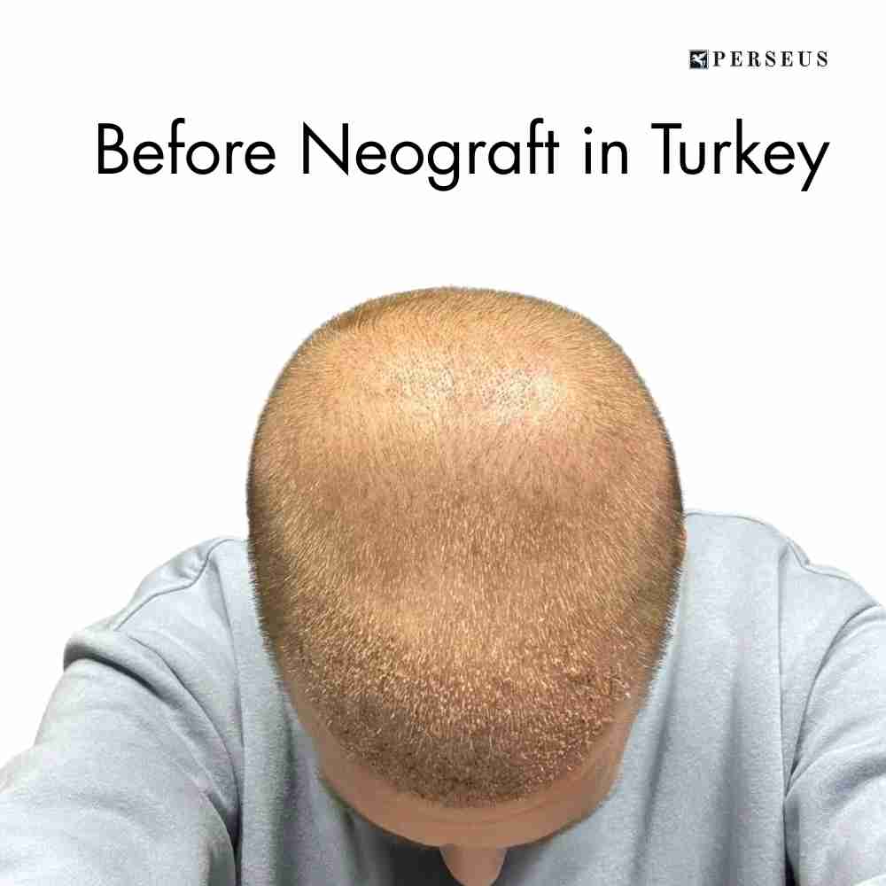 Experience Neograft Hair Transplant in Turkey, Istanbul - Perseus Hair Care