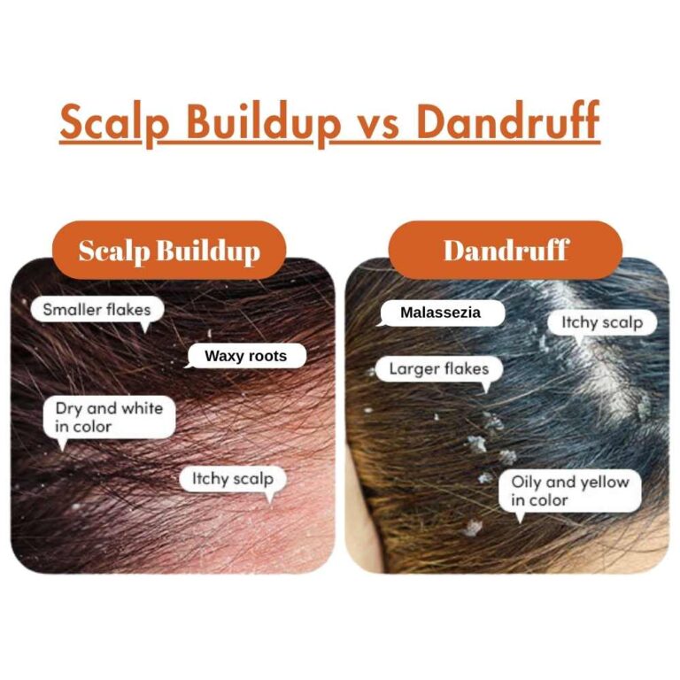How to Deal with Scalp Buildup: Causes, Symptoms & Treatments