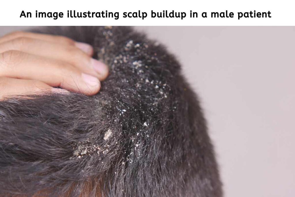 Scalp Buildup: Causes, Signs & How to Remove It Faster