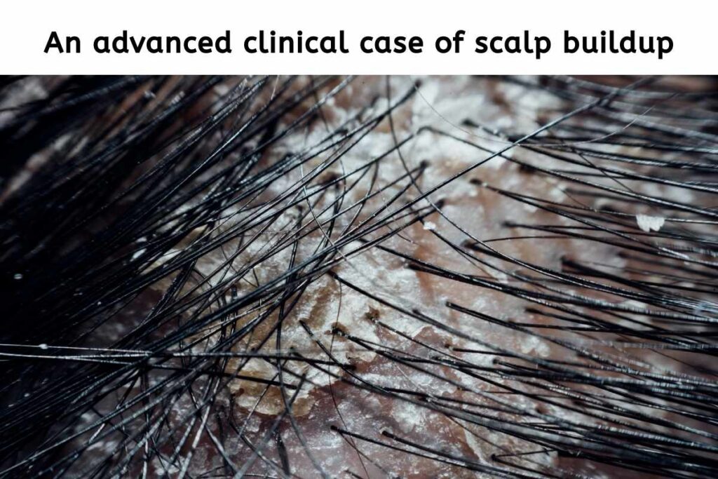 Scalp Buildup: Causes, Signs & How to Remove It Faster